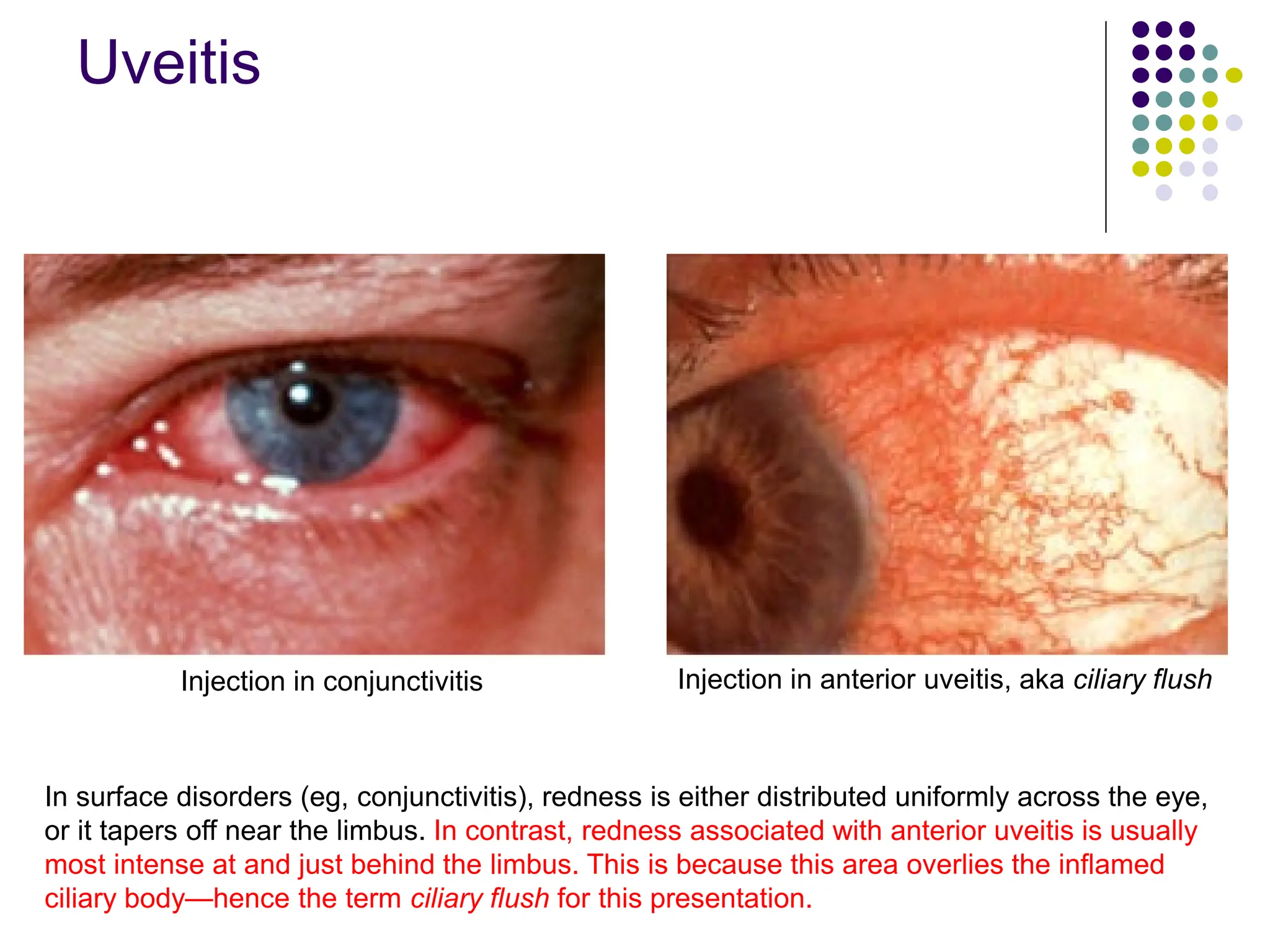 Uveitis in the eye anterior uvitis and posterior uveitis | PDF | Eye and Vision Conditions ...