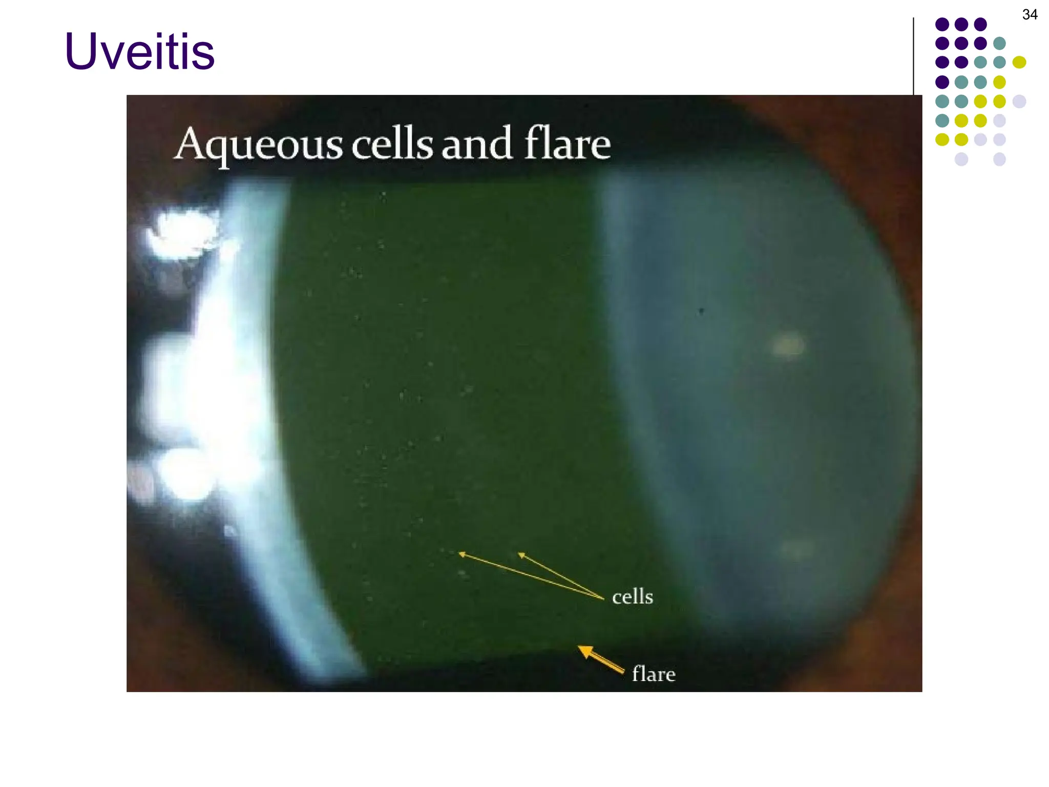 Uveitis in the eye anterior uvitis and posterior uveitis | PDF