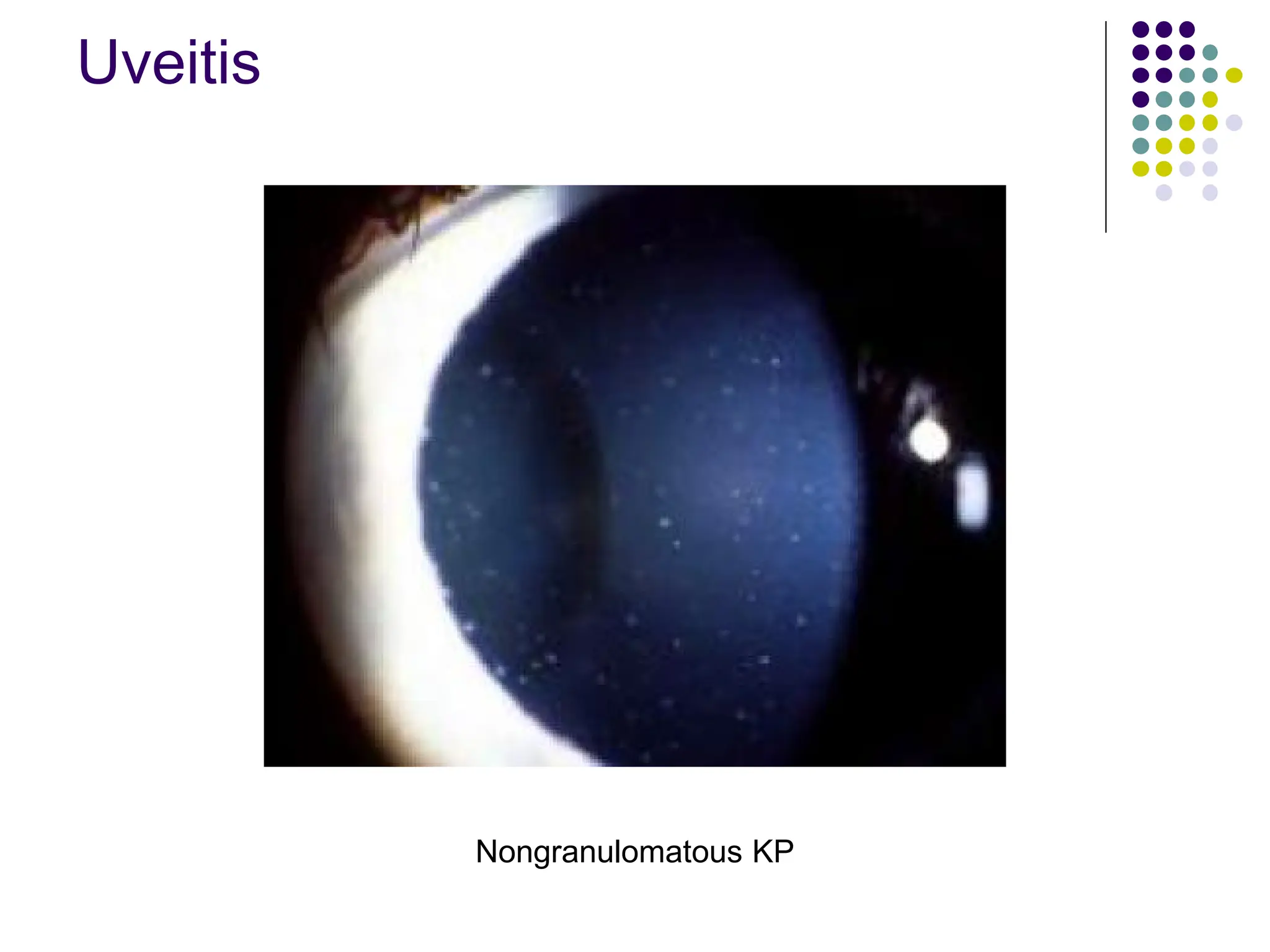 Uveitis in the eye anterior uvitis and posterior uveitis | PDF
