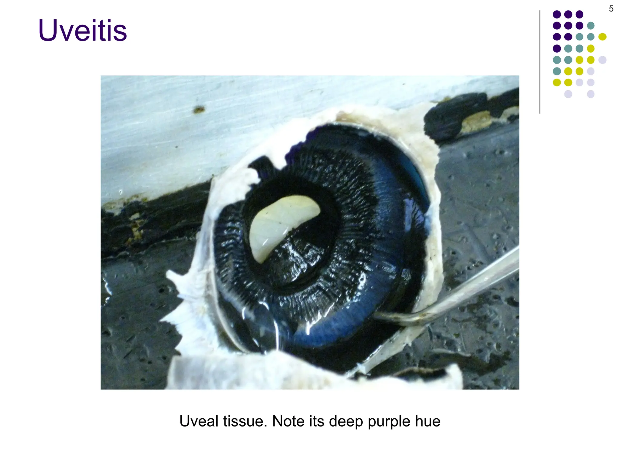 Uveitis in the eye anterior uvitis and posterior uveitis | PDF