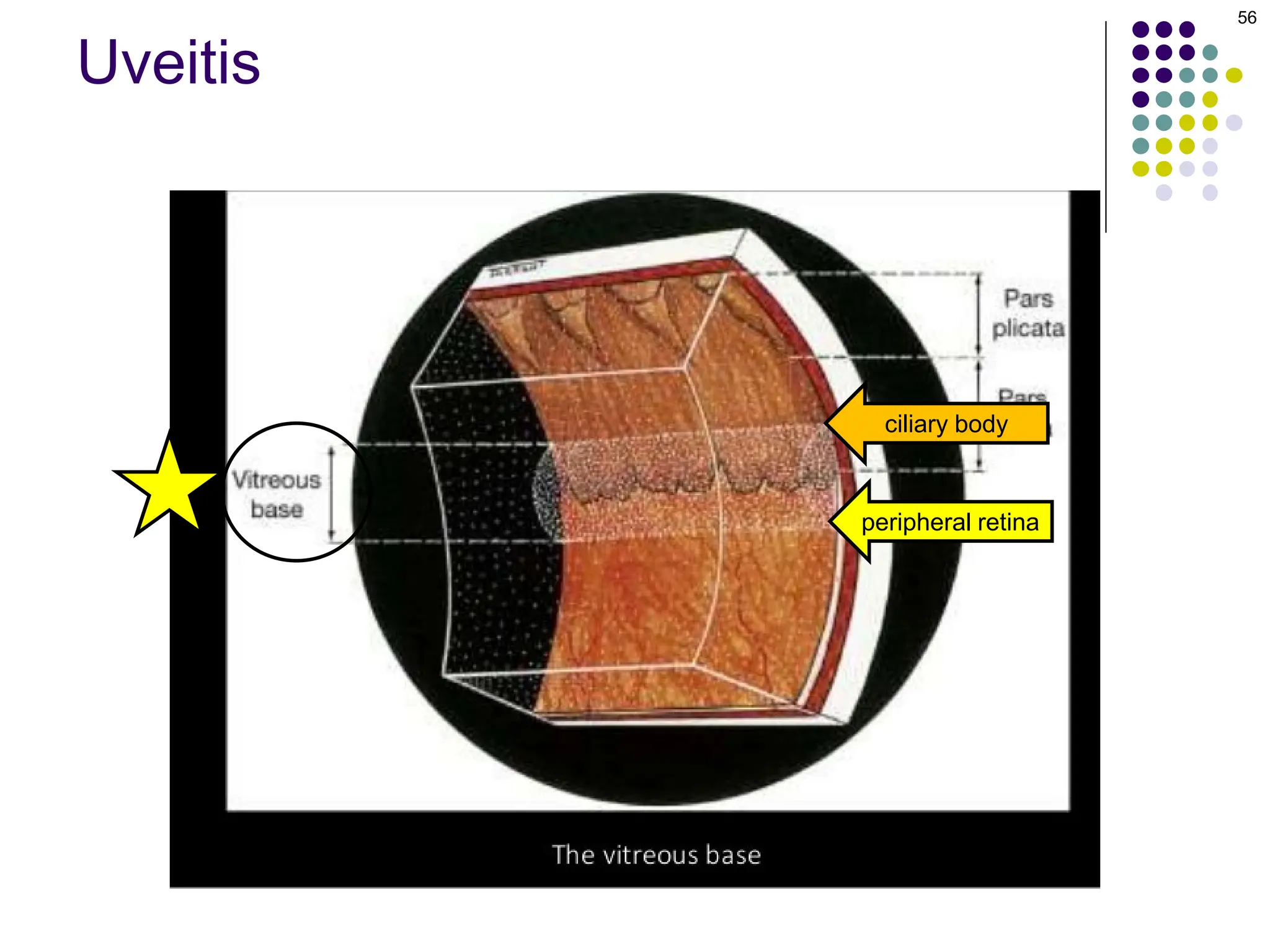 Uveitis in the eye anterior uvitis and posterior uveitis | PDF