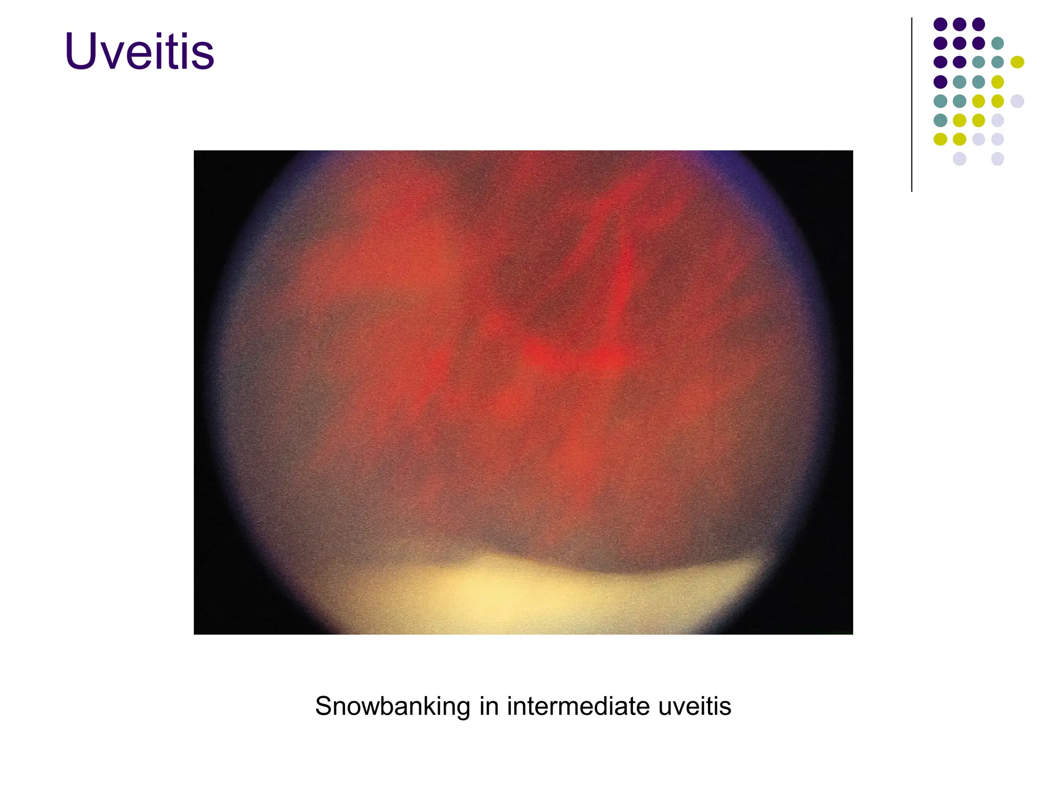 Uveitis in the eye anterior uvitis and posterior uveitis | PDF