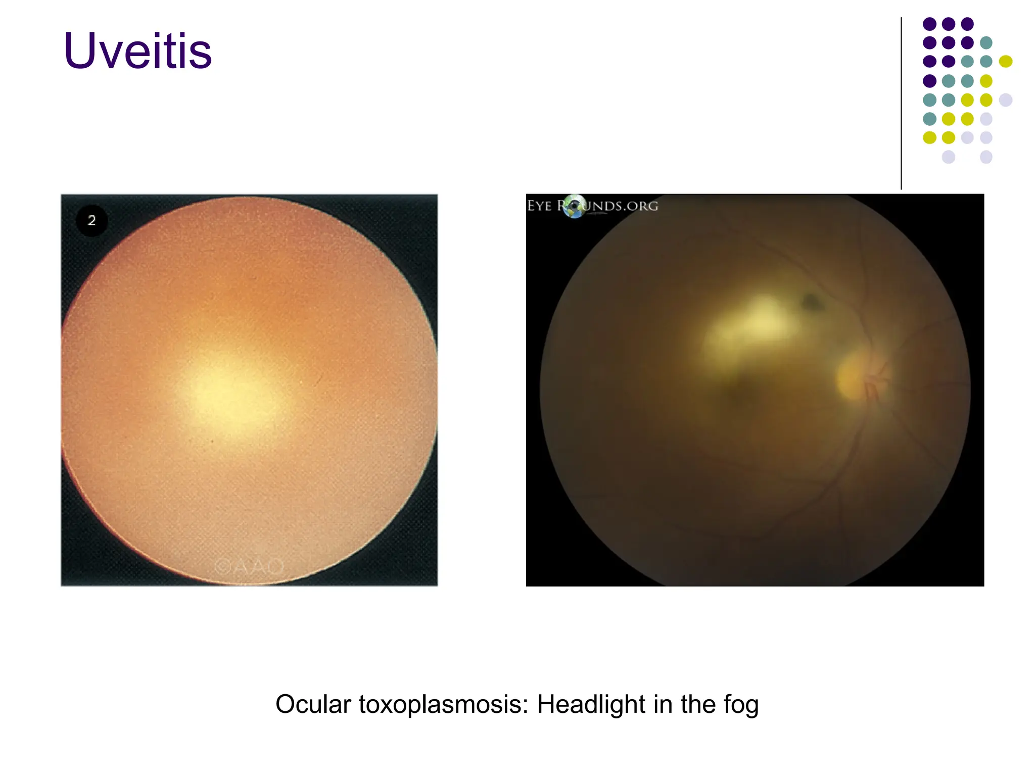Uveitis in the eye anterior uvitis and posterior uveitis | PDF