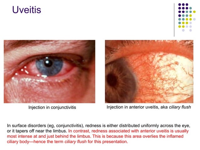 Uveitis In The Eye Anterior Uvitis And Posterior Uveitis Pdf Eye And Vision Conditions