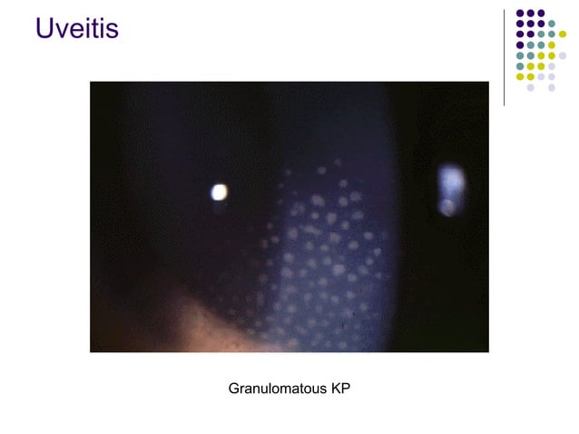 Uveitis in the eye anterior uvitis and posterior uveitis | PDF | Eye and Vision Conditions ...
