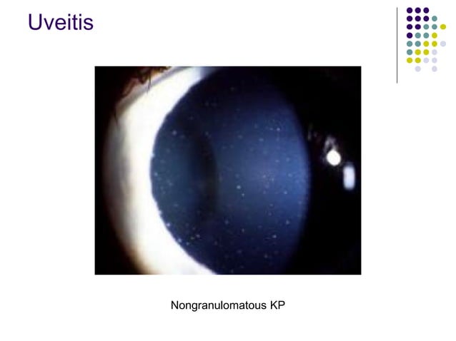 Uveitis in the eye anterior uvitis and posterior uveitis | PDF | Eye and Vision Conditions ...