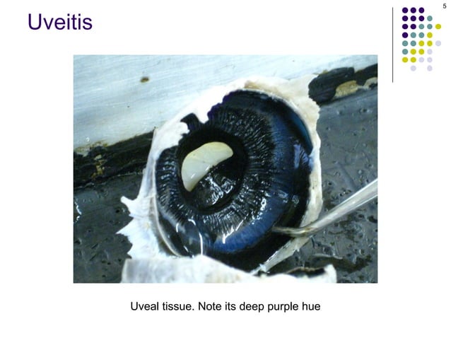 Uveitis in the eye anterior uvitis and posterior uveitis | PDF | Eye ...