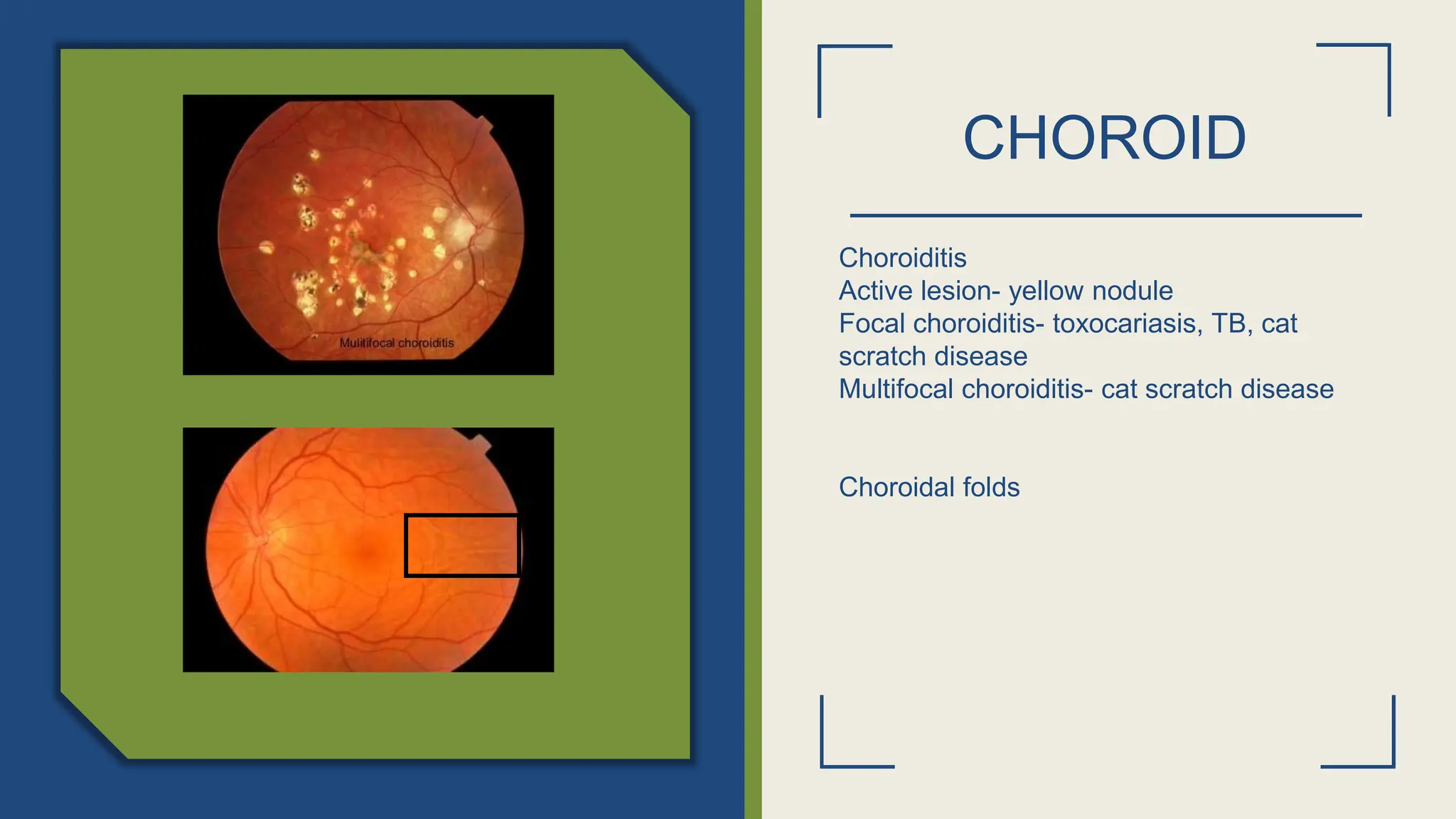 Uveitis its clinical features and management.pptx