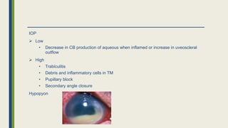 Uveitis its clinical features and management.pptx