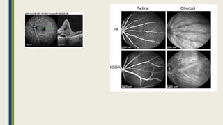 Uveitis its clinical features and management.pptx