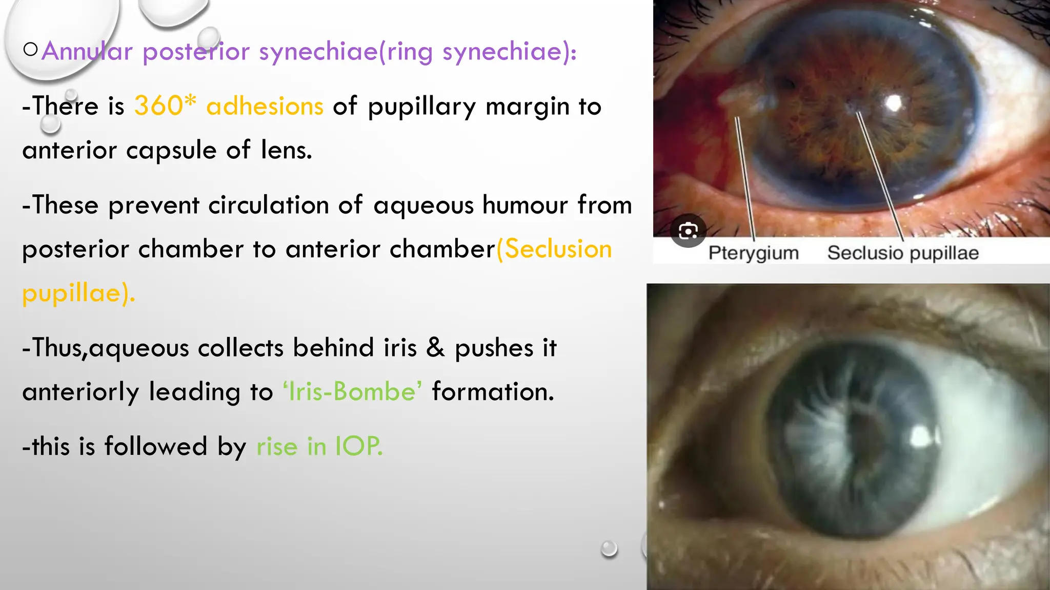 uveitis of the anterior segment and posterior segment | PPTX