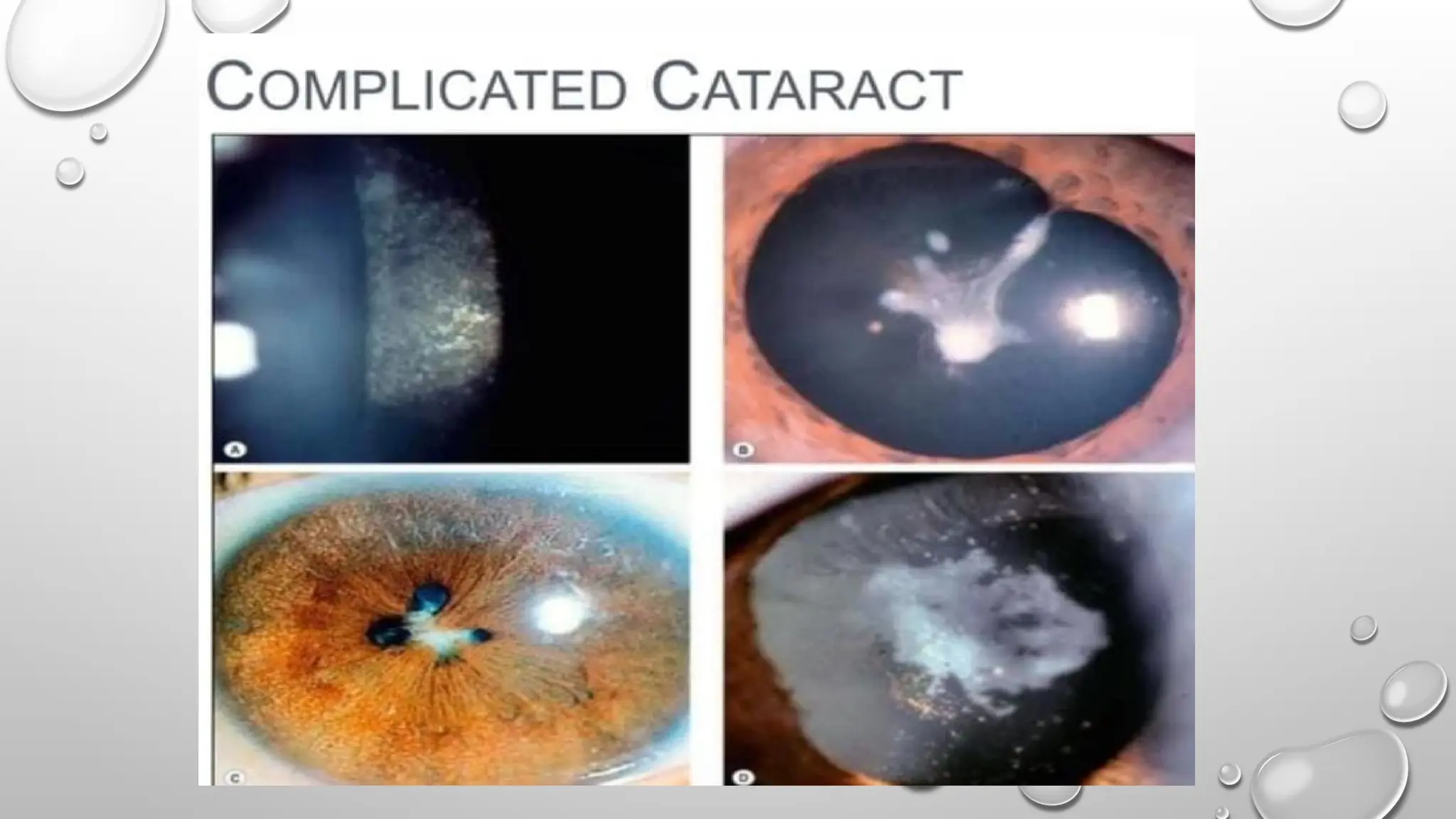 uveitis of the anterior segment and posterior segment | PPTX