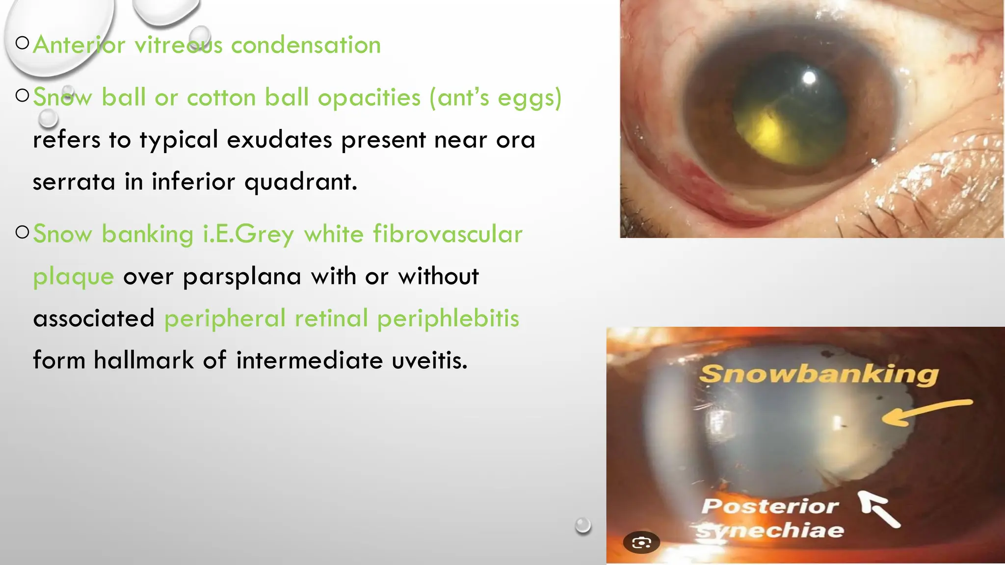 uveitis of the anterior segment and posterior segment | PPTX