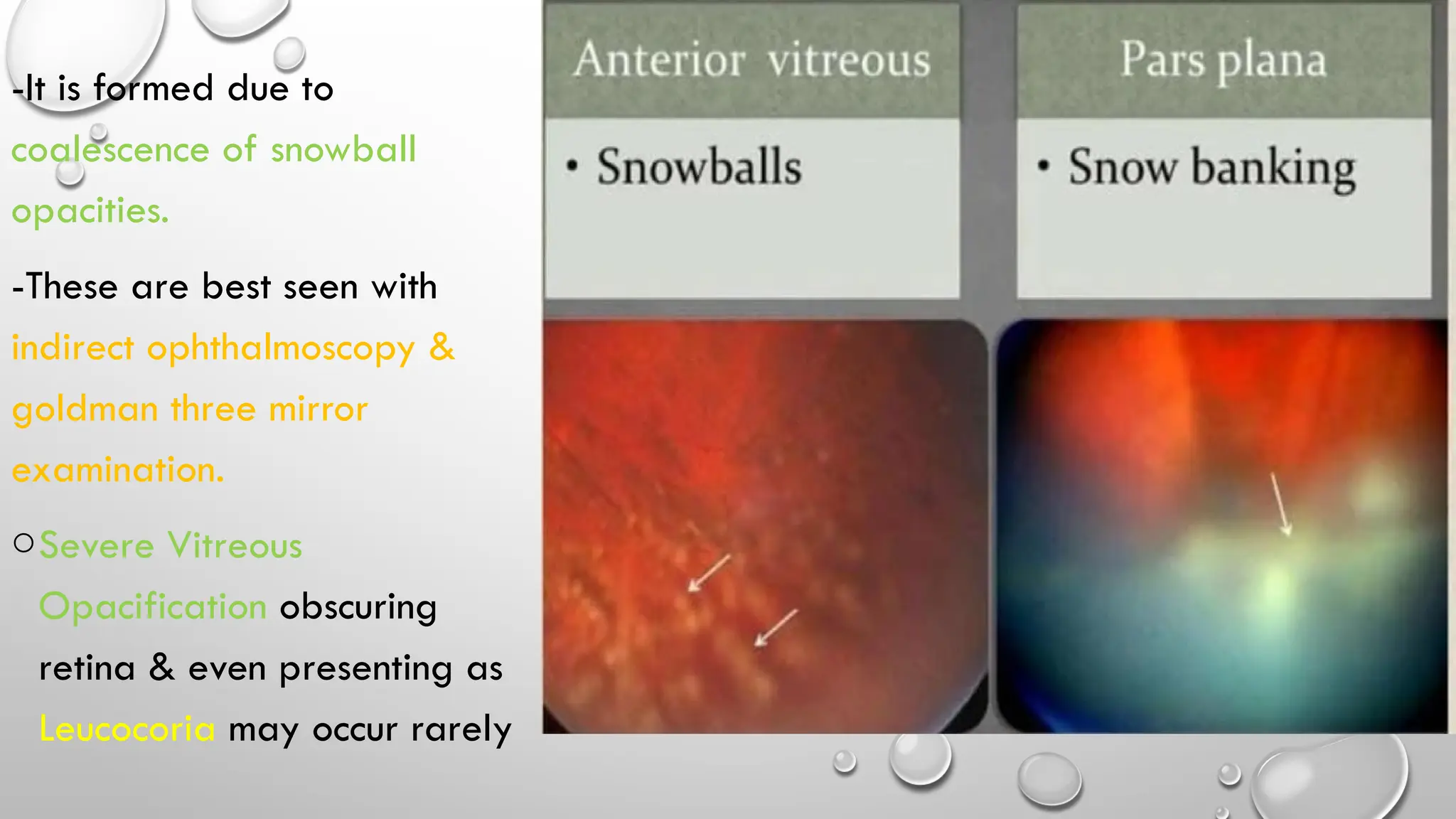 uveitis of the anterior segment and posterior segment | PPTX