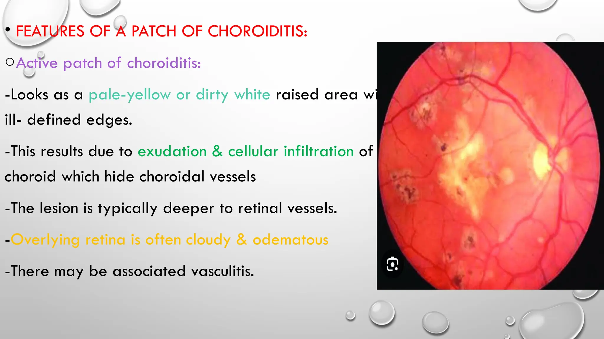 uveitis of the anterior segment and posterior segment | PPTX | Eye and ...
