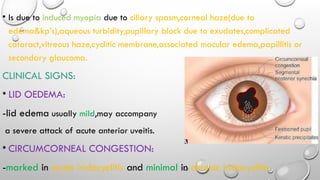 uveitis of the anterior segment and posterior segment | PPTX