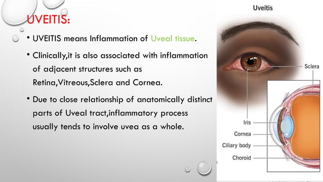 uveitis of the anterior segment and posterior segment | PPTX | Eye and Vision Conditions ...