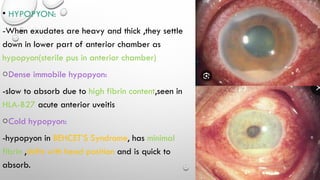 uveitis of the anterior segment and posterior segment | PPTX