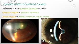 uveitis of the anterior segment and posterior segment | PPTX