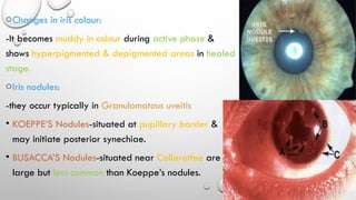 uveitis of the anterior segment and posterior segment | PPTX