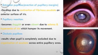 uveitis of the anterior segment and posterior segment | PPTX