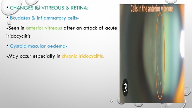 uveitis of the anterior segment and posterior segment | PPTX | Eye and ...