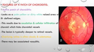 uveitis of the anterior segment and posterior segment | PPTX