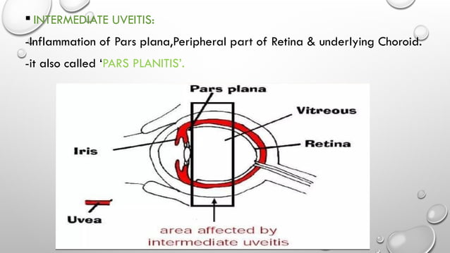 uveitis of the anterior segment and posterior segment | PPTX | Eye and ...