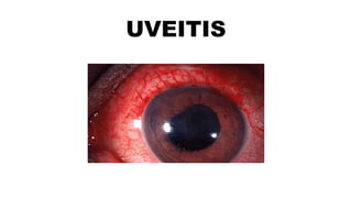 UVEITIS exam reference notes important.pptx