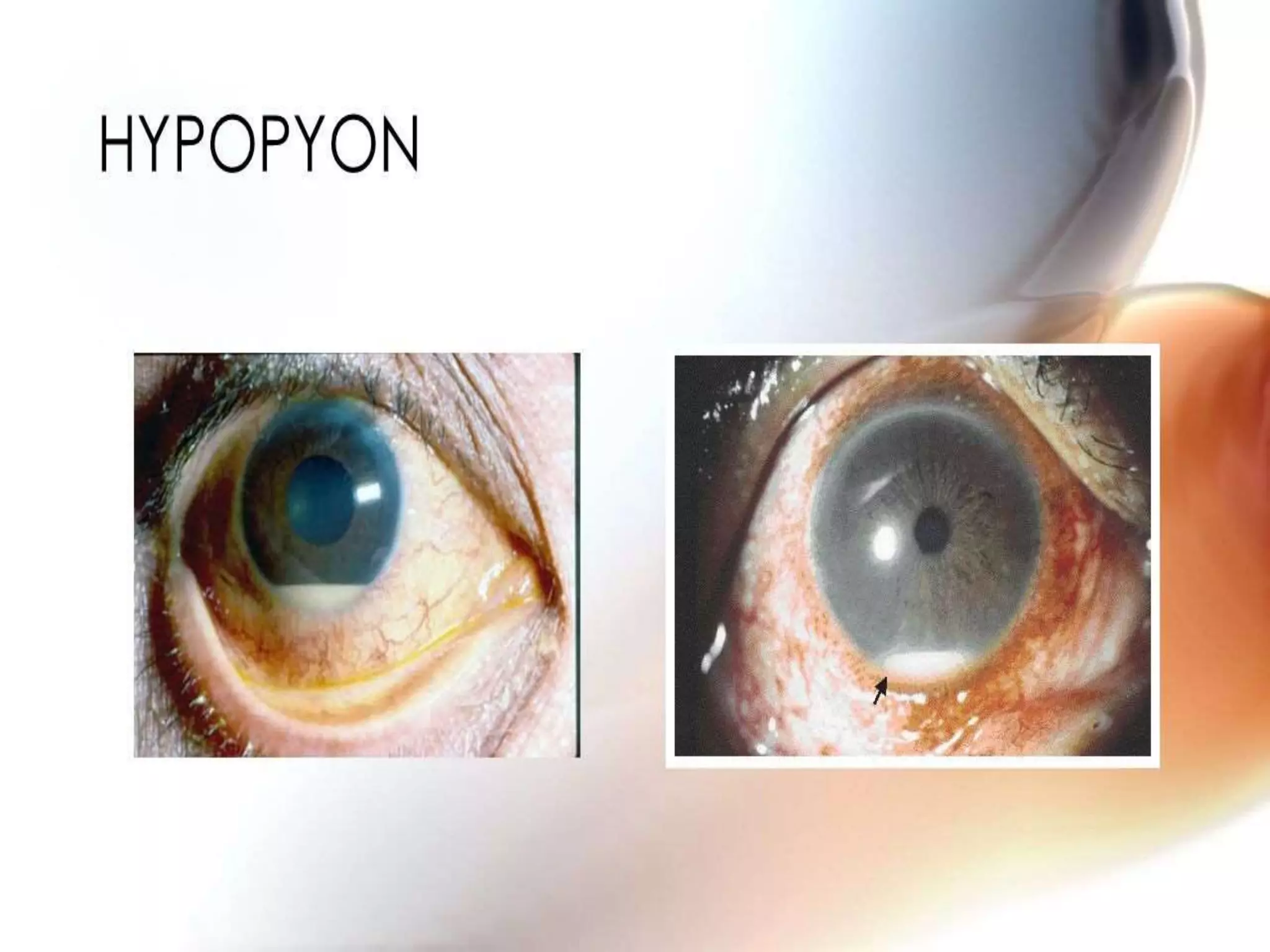Uveitis | PPTX