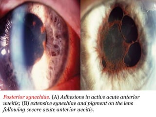 Uveitis | PPTX