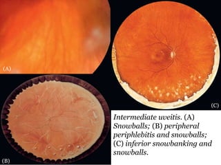 Uveitis | PPTX