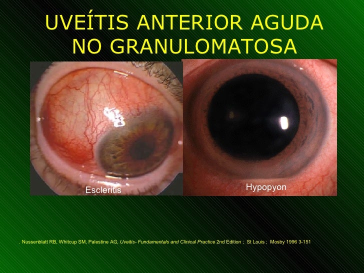 Uveitis Hla B27