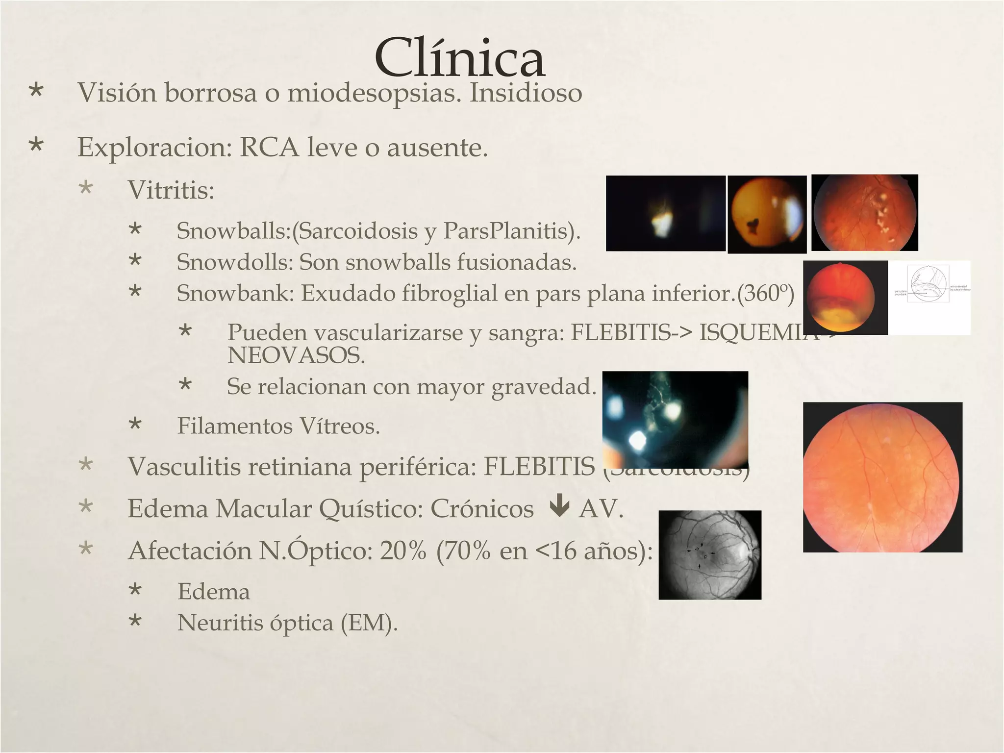 Uveitis Intermedias | PPT | Eye and Vision Conditions | Diseases and ...