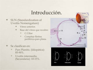 Uveitis Intermedias | PPT