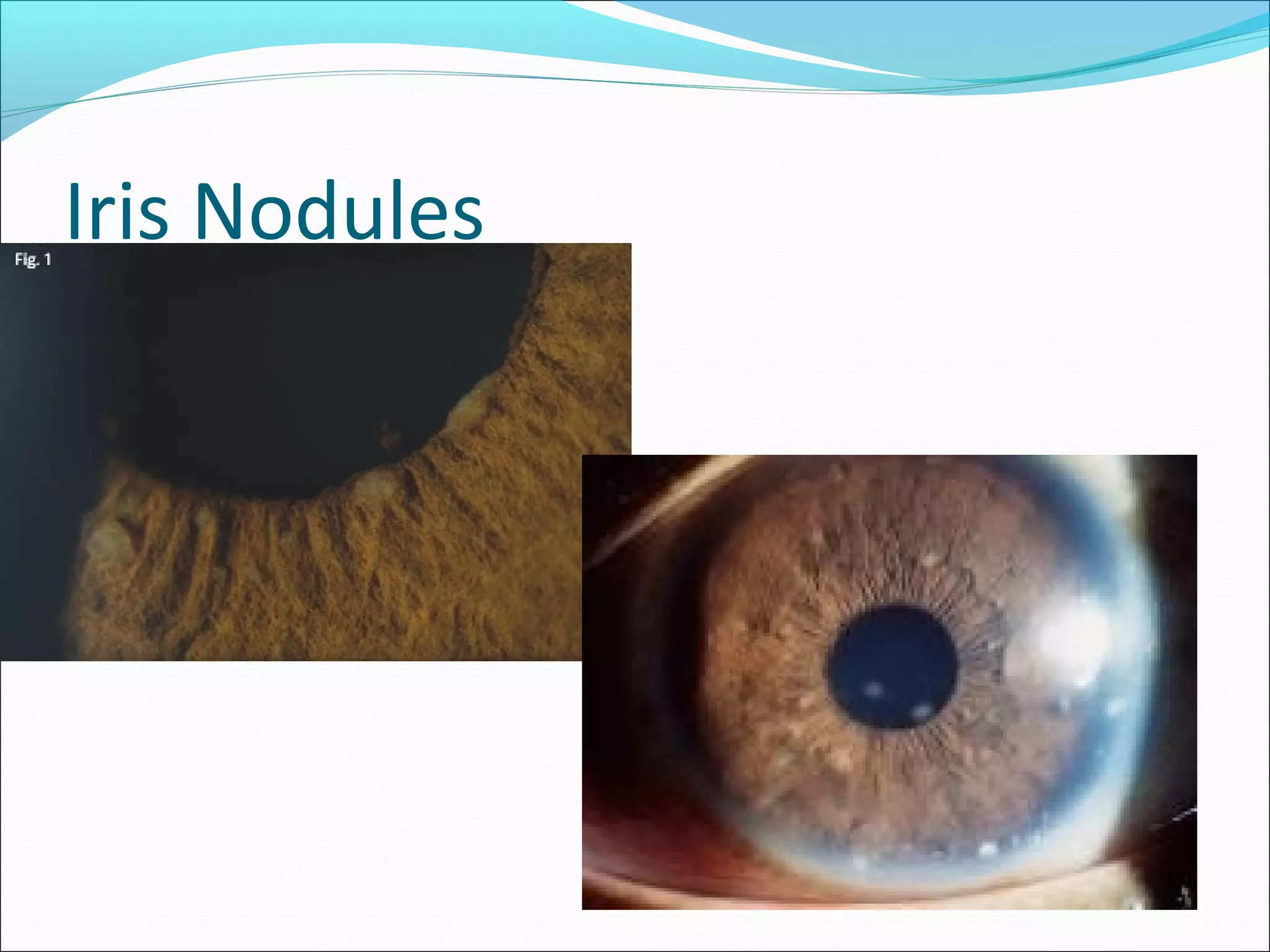 Uveitis | PPT | Eye and Vision Conditions | Diseases and Conditions