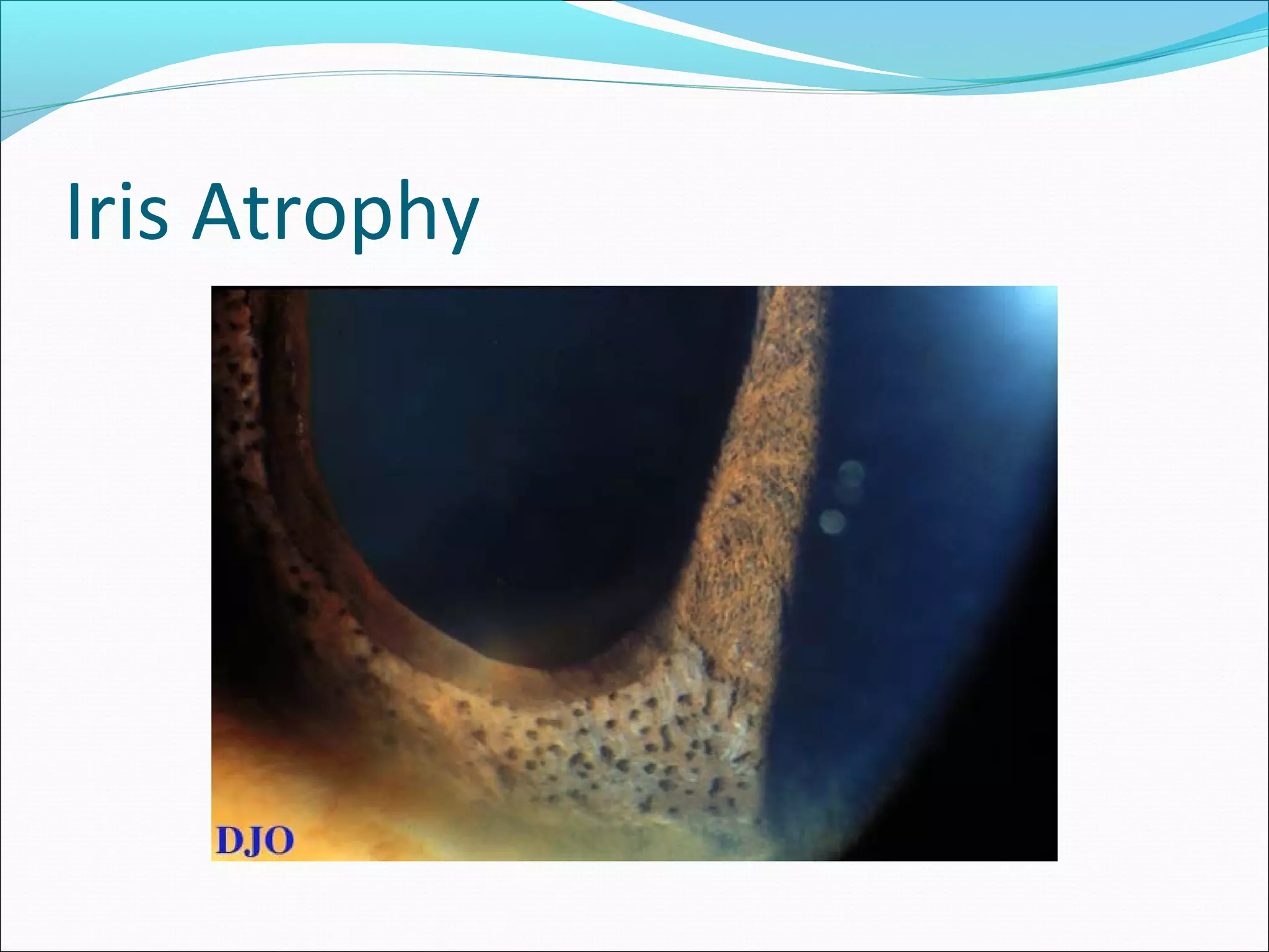 Uveitis | PPT