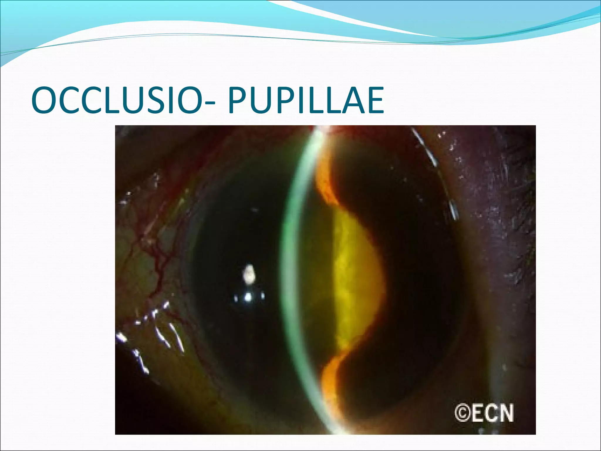 Uveitis | PPT