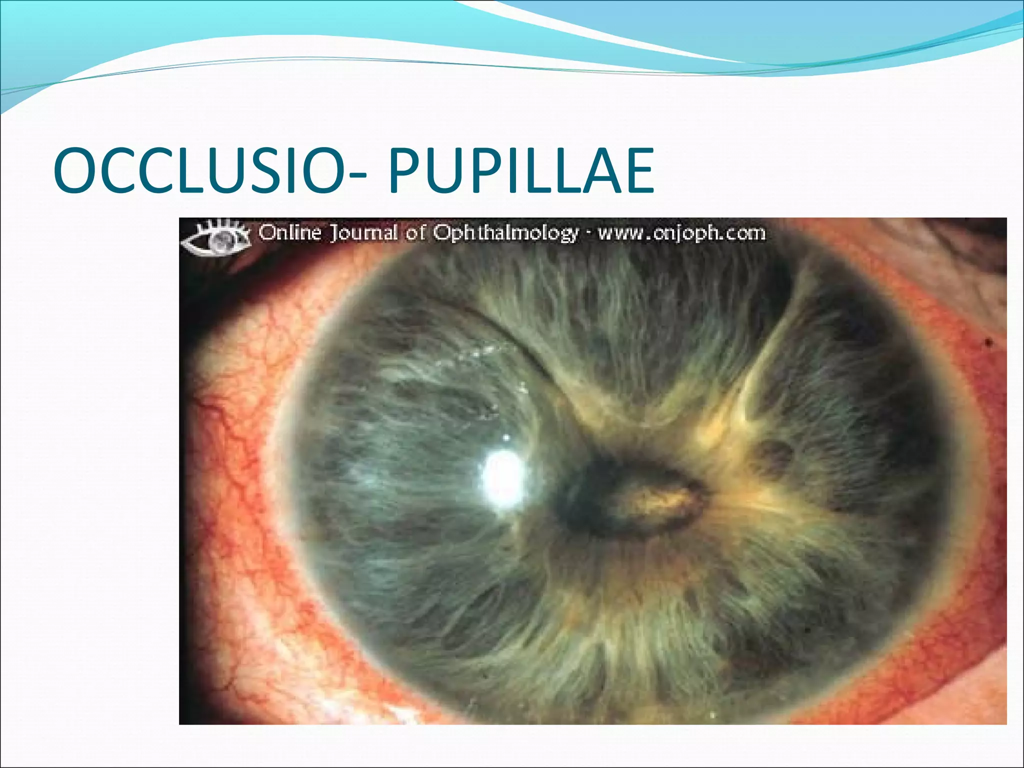 Uveitis | PPT | Eye and Vision Conditions | Diseases and Conditions