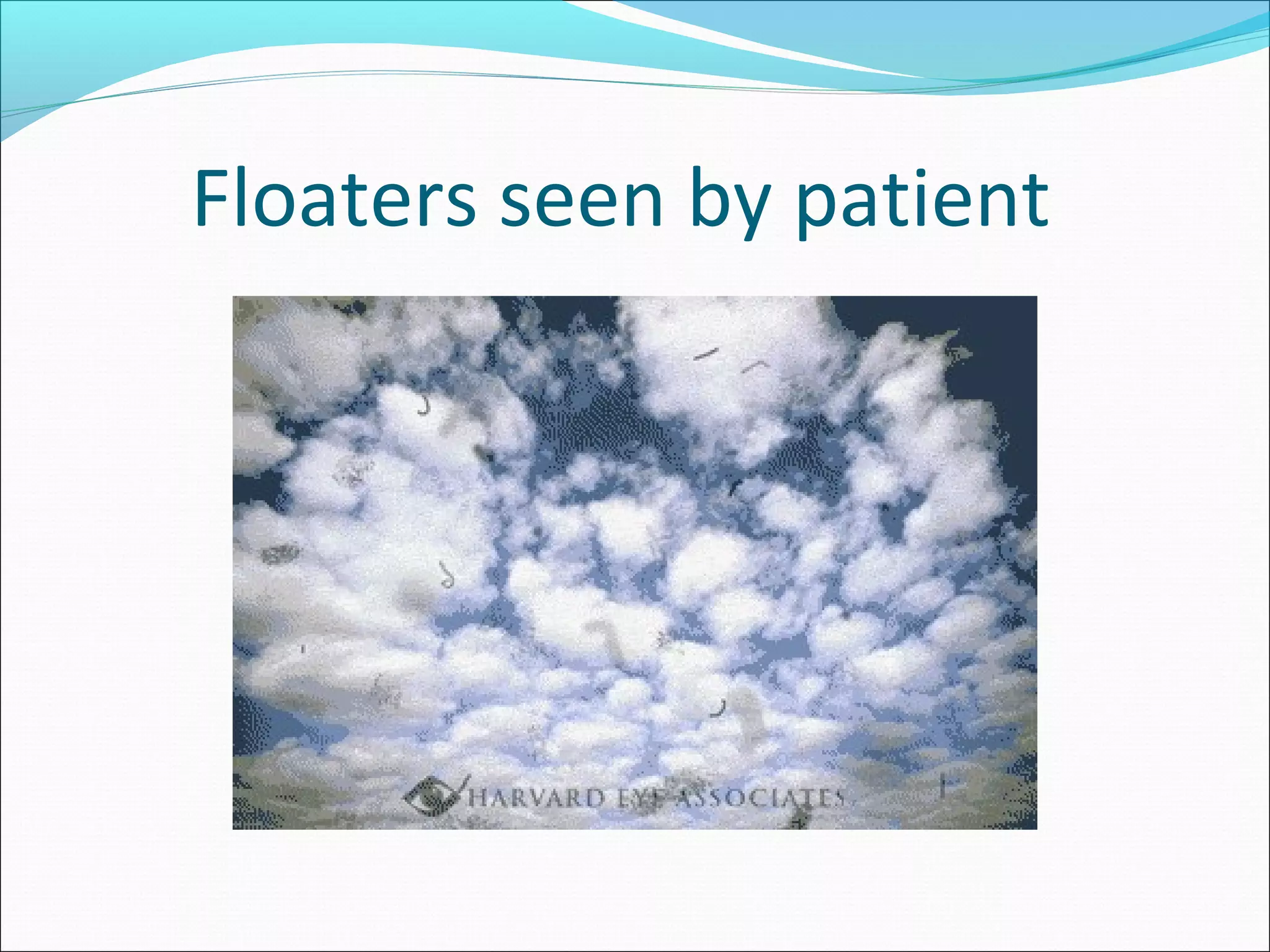Uveitis | PPT