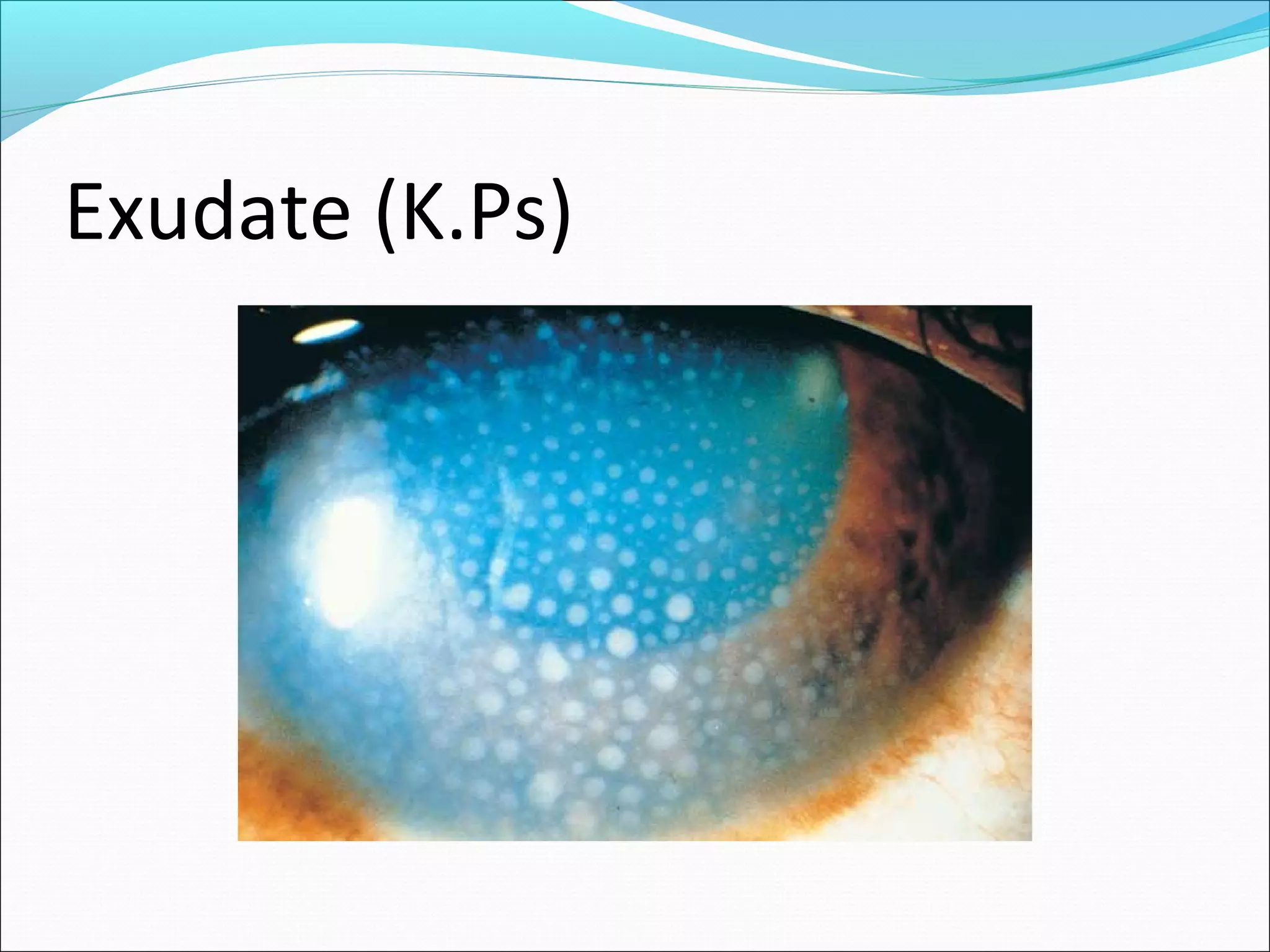 Uveitis | PPT | Eye and Vision Conditions | Diseases and Conditions