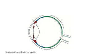 Aetiology and classification of uveitis. | PPTX