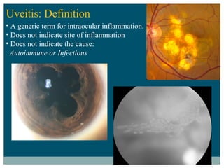 Review of Uveitis | PPT