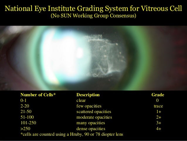Review of Uveitis