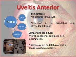 Uveitis anterior memo | PPTX