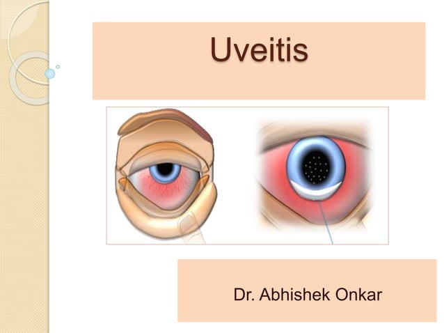 Uveitis basics for undergrads | PPT