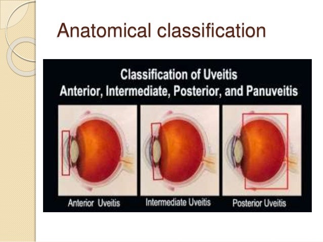 Uveitis basics for undergrads