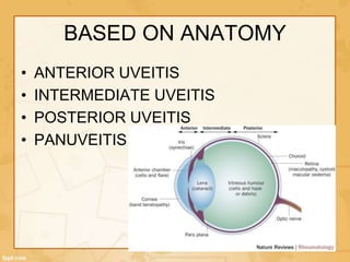 Anterior Uveitis Posterior Uveitis And Panuveitis Etiology Symptoms