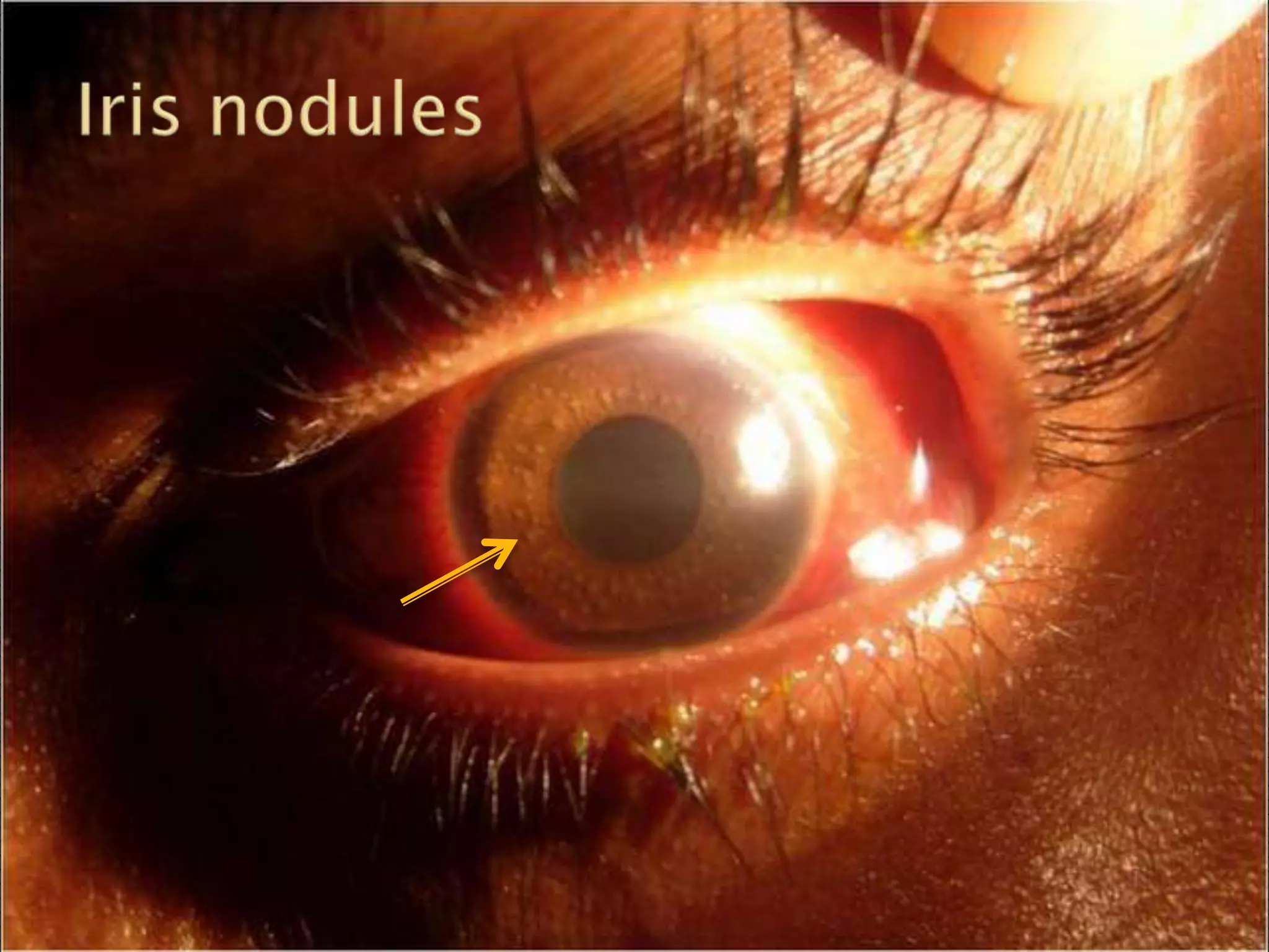 Common Causes of Uveitis Part1 | PPTX | Eye and Vision Conditions ...