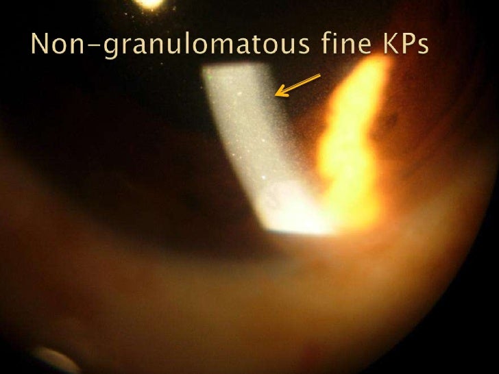 Common Causes of Uveitis Part1